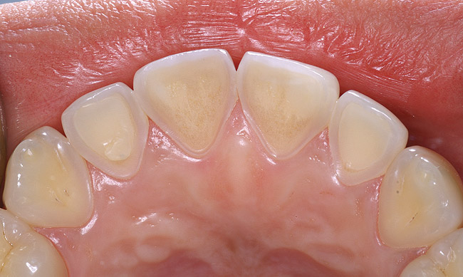Enamel Erosion What Is It And Why Is Tooth Erosion So Commonenamel Erosion Why Is It So Common